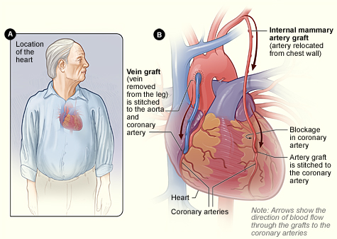 Coronary Artery Bypass Grafting CABG Surgery Education Portal